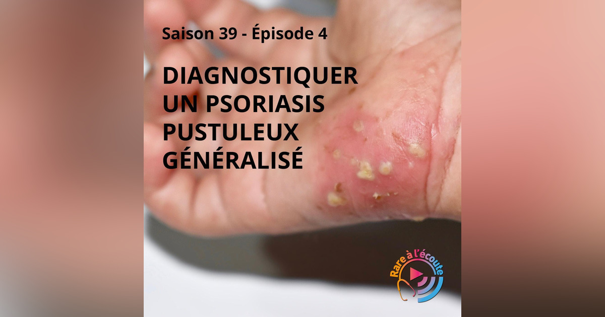 Maladie rare - Diagnostiquer un Psoriasis Pustuleux Généralisé ...